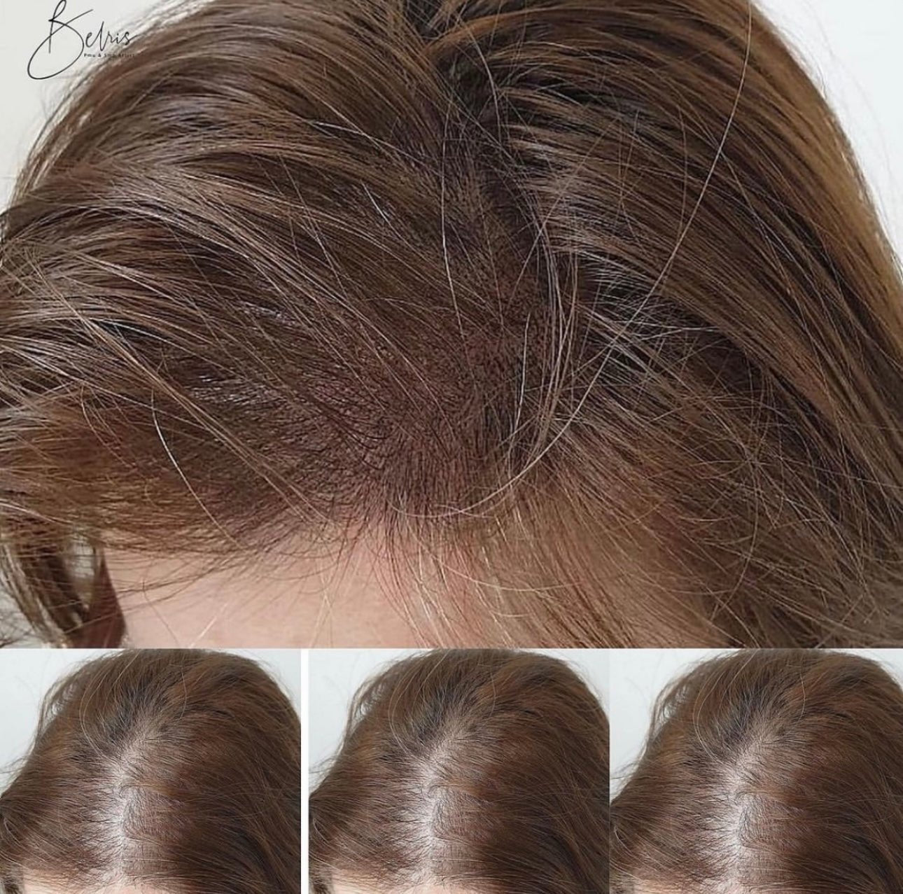 What is Scalp Micropigmentation? A Hair Loss Game-Changer